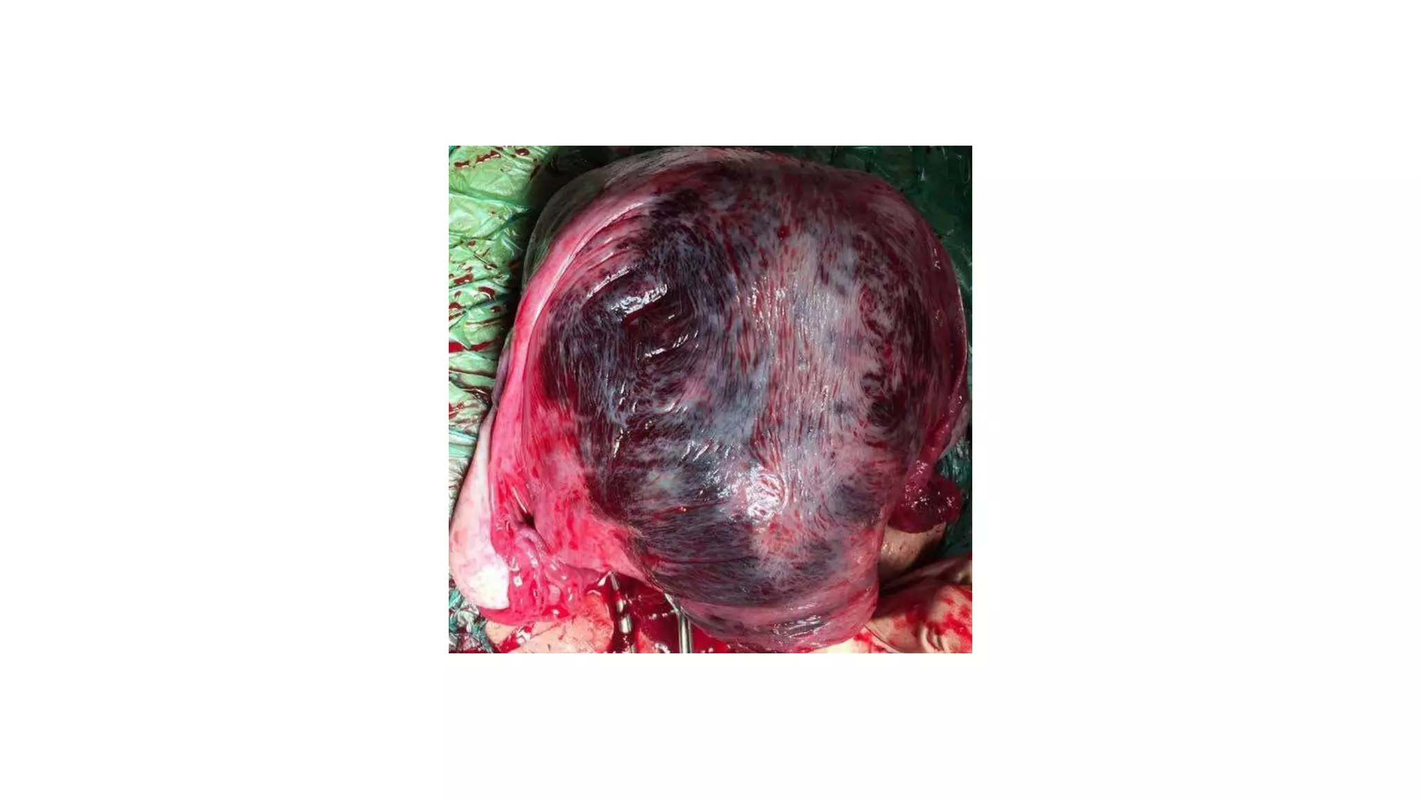 abruptio placentae.pptx