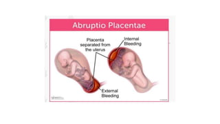ABRUPTIO PLACENTAE ppt.pptx