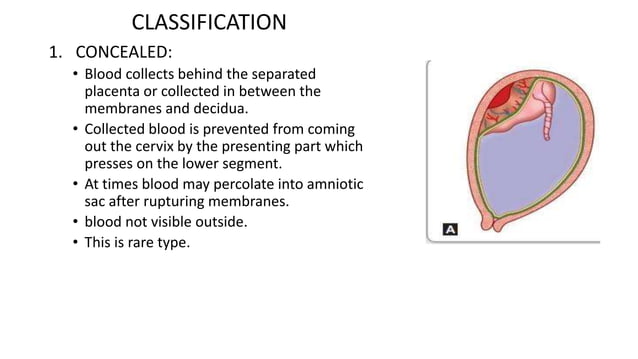 ABRUPTIO PLACENTAE ppt.pptx