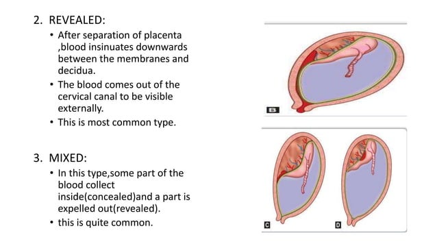 ABRUPTIO PLACENTAE ppt.pptx