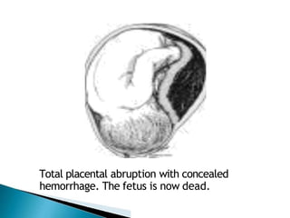 ABRUPTIO PLACENTEA AND ITS MANAGEMENT .pptx