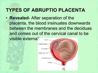 ABRUPTIO PLACENTAE | PPTX