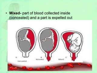 Abruptio Placentae Types