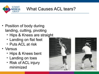The Treatment of ACL Tears | PPT