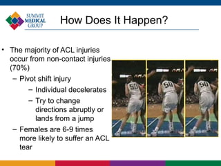 The Treatment of ACL Tears | PPT