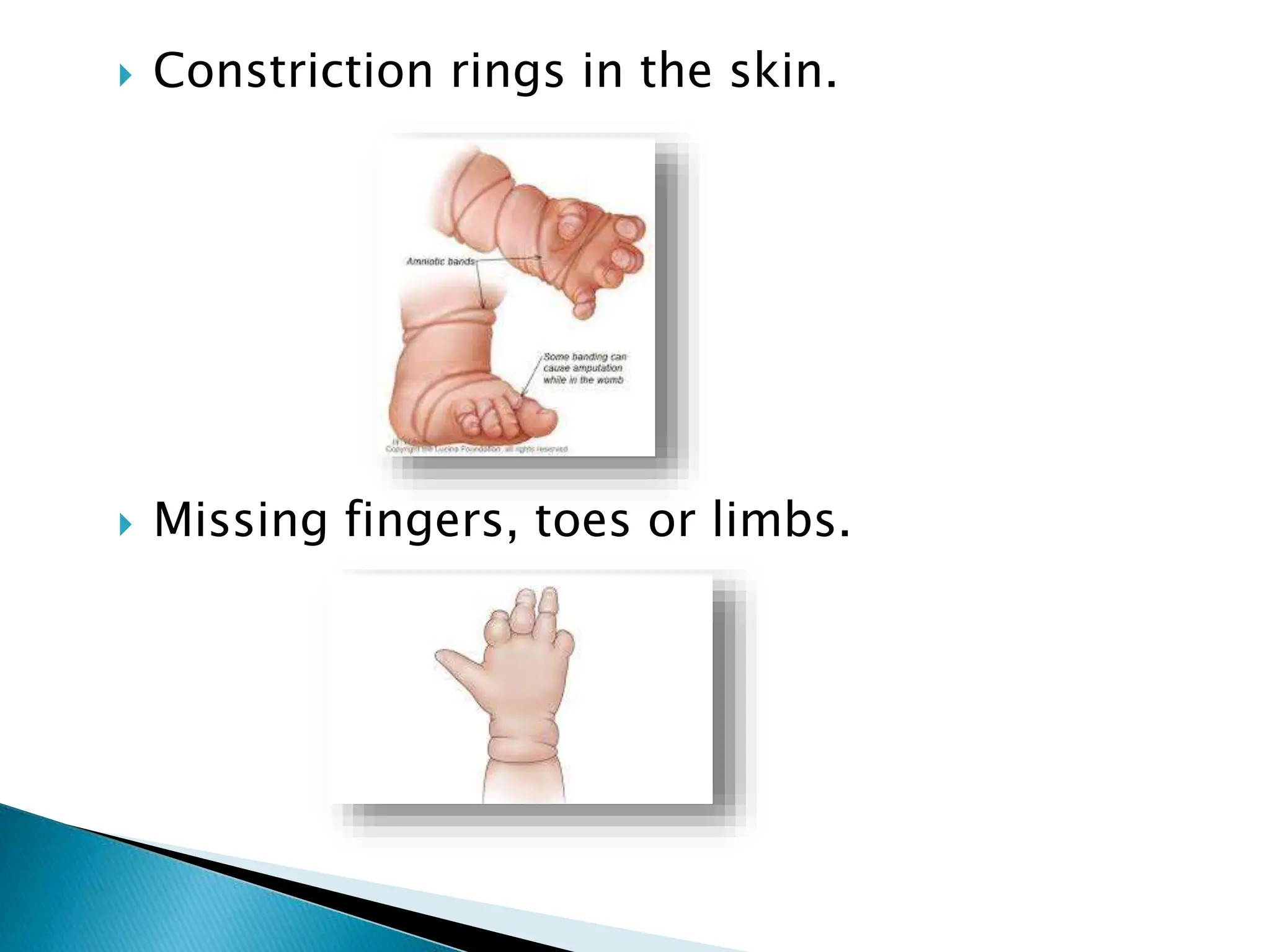 ABS AMNIOTIC BAND SYNDROM ORTHOPEDIE.pptx