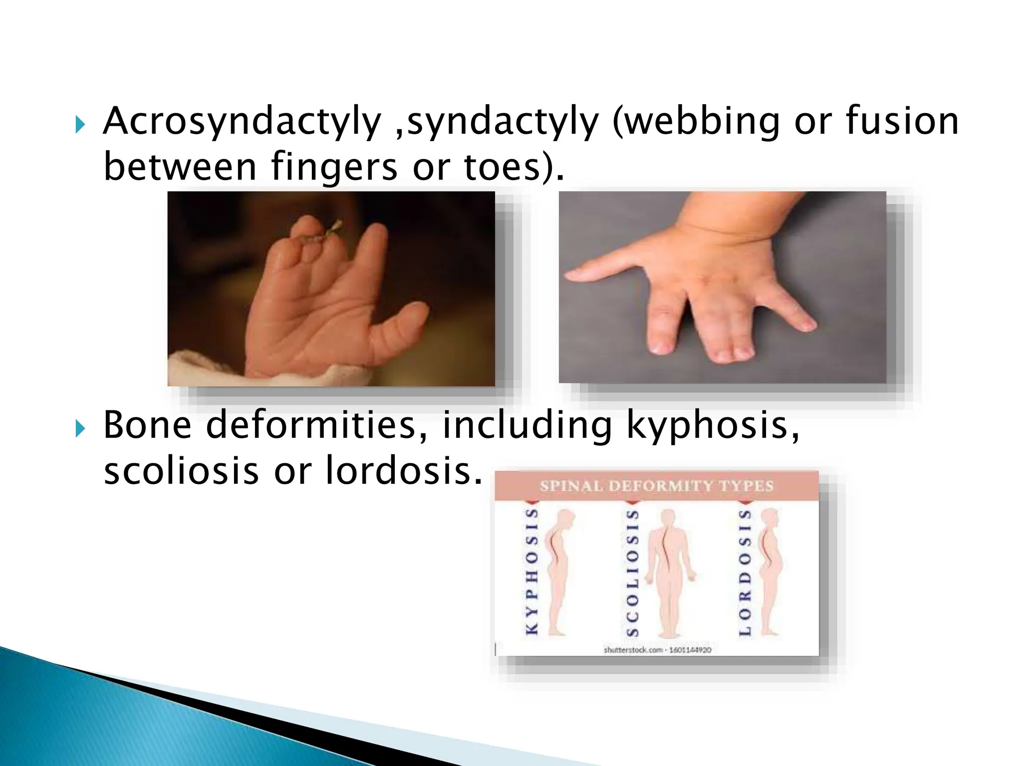 ABS AMNIOTIC BAND SYNDROM ORTHOPEDIE.pptx
