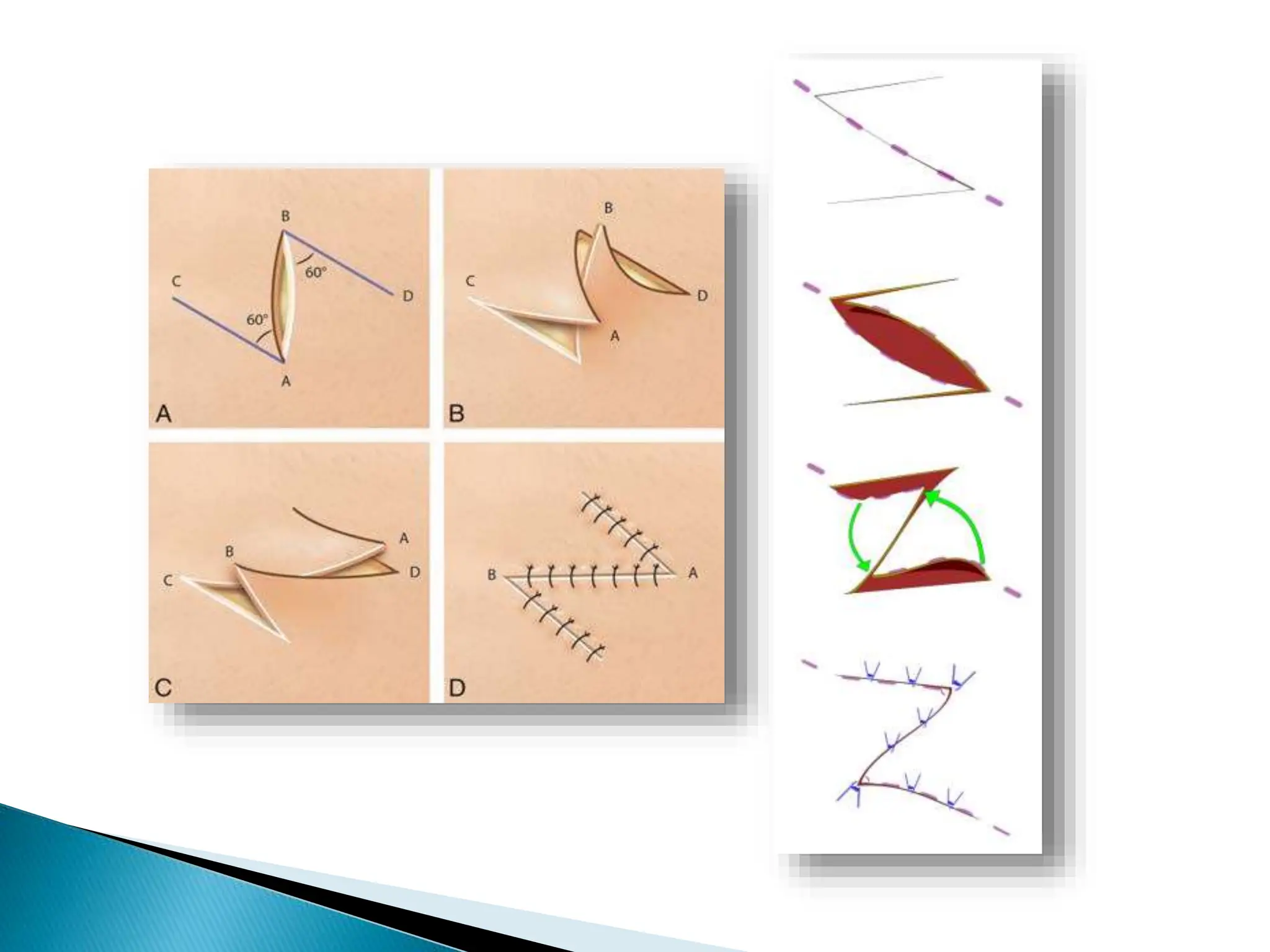 ABS AMNIOTIC BAND SYNDROM ORTHOPEDIE.pptx