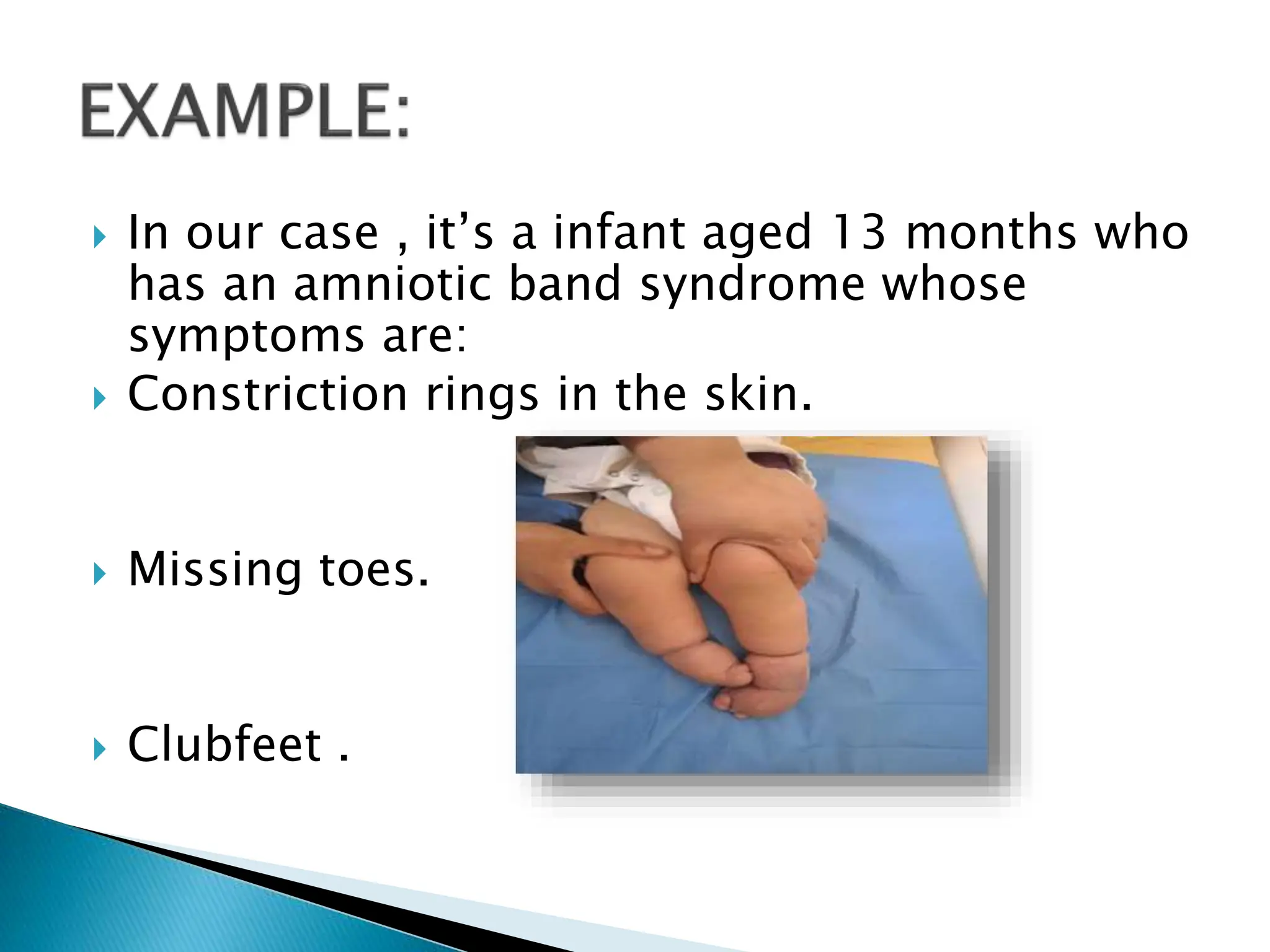 ABS AMNIOTIC BAND SYNDROM ORTHOPEDIE.pptx