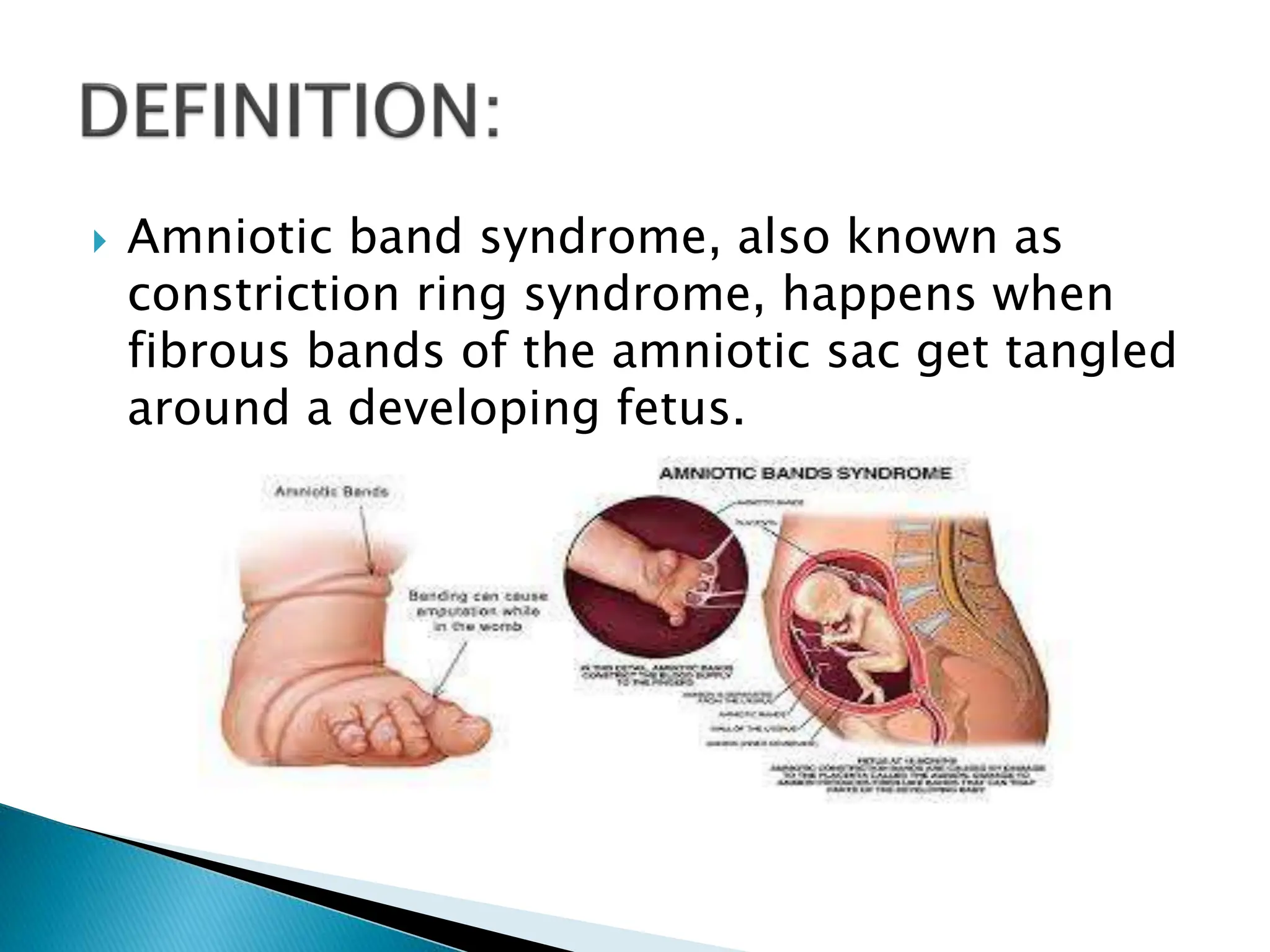 ABS AMNIOTIC BAND SYNDROM ORTHOPEDIE.pptx