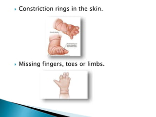 ABS AMNIOTIC BAND SYNDROM ORTHOPEDIE.pptx