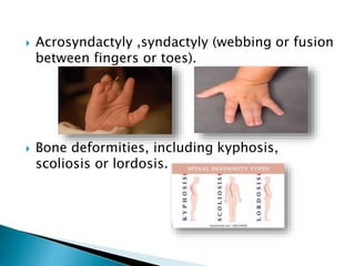 ABS AMNIOTIC BAND SYNDROM ORTHOPEDIE.pptx