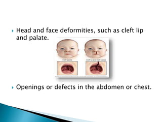 ABS AMNIOTIC BAND SYNDROM ORTHOPEDIE.pptx