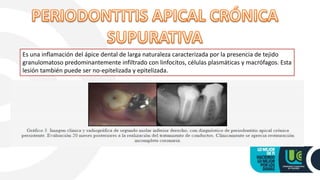 Absceso apical agudo y crónico | PPTX