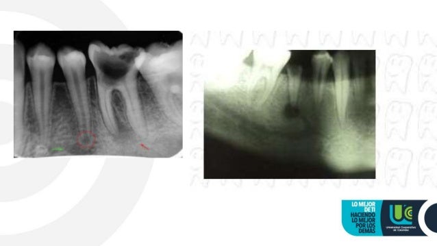 Absceso apical agudo y crónico