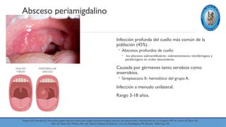 Abordaje de absceso amigdalino en pediatria | PPTX