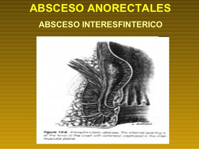 Anatomia Do Abscesso Anorretal Absceso Anorectal Dr Miranda