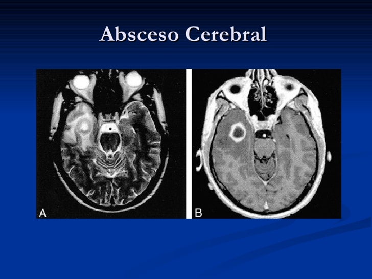 Absceso Cerebral