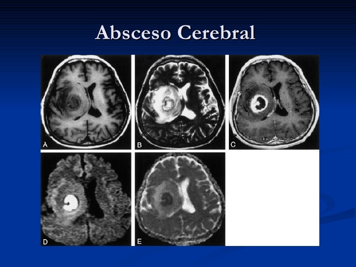 Absceso Cerebral