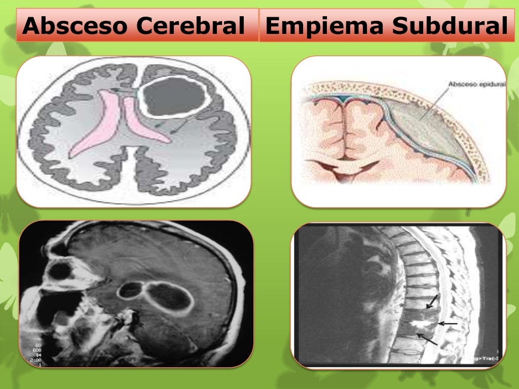 Absceso cerebral