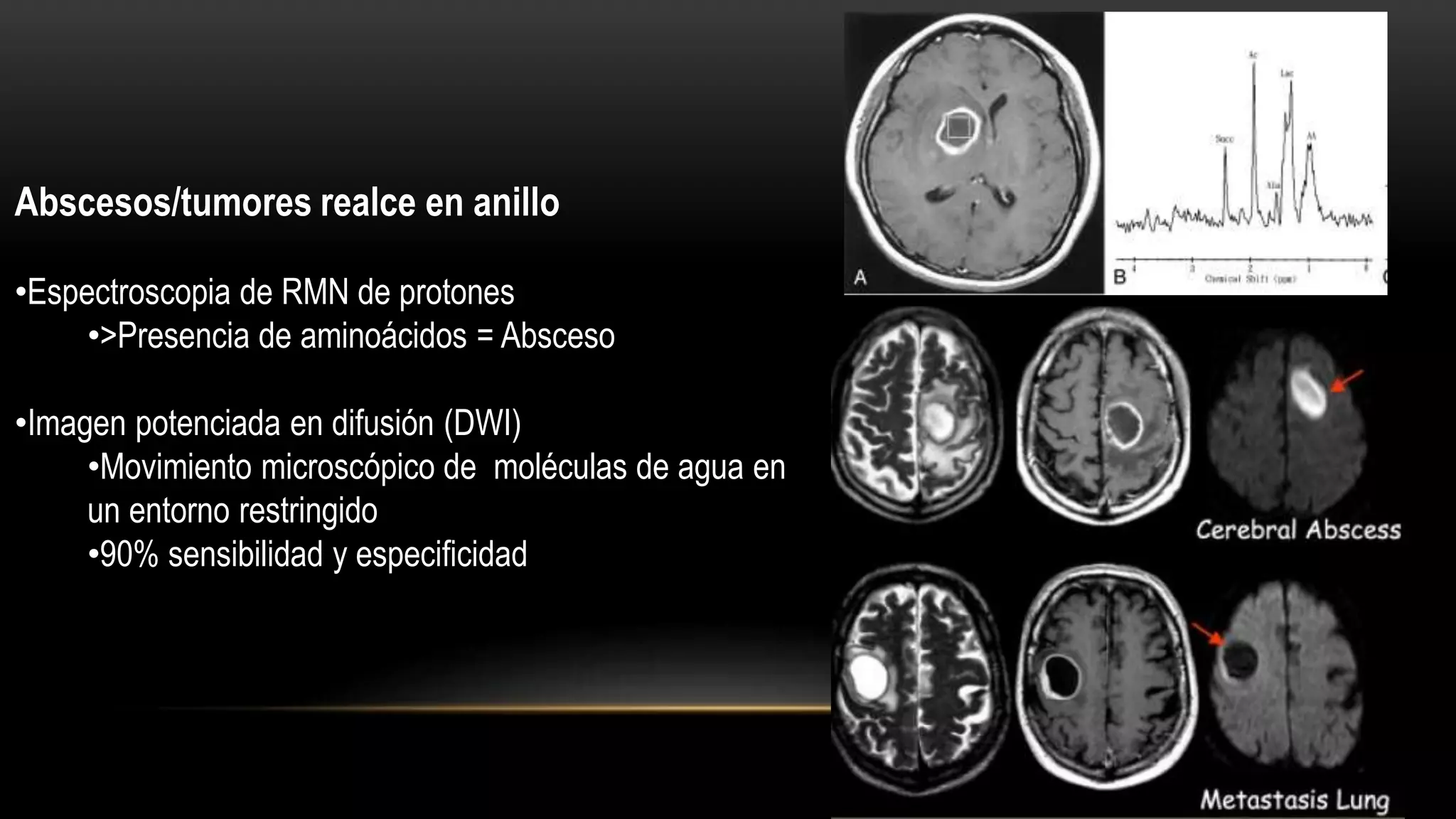 Absceso Cerebral | PPTX | Brain and Nervous System Disorders | Diseases ...