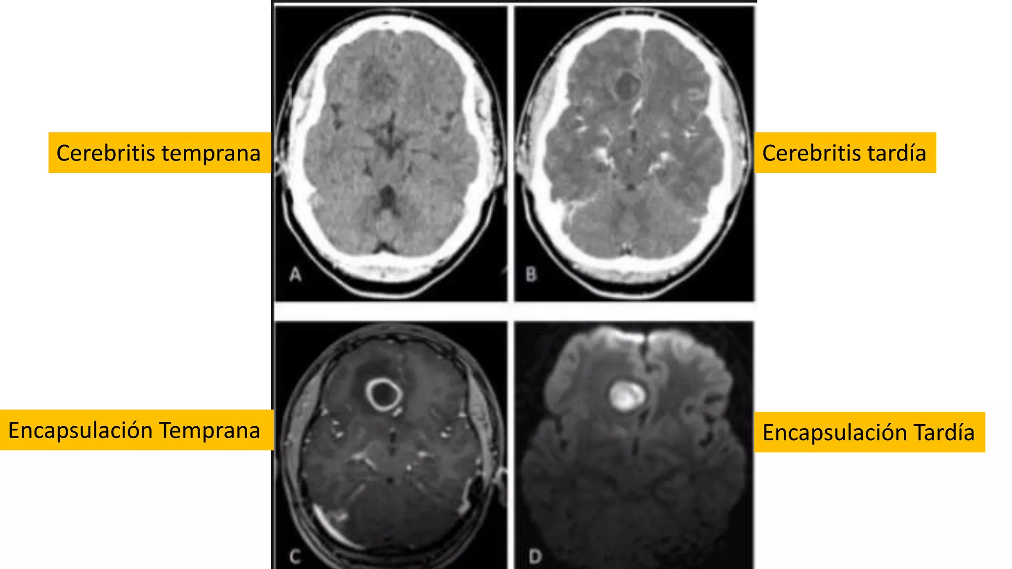 Absceso cerebral | PPT
