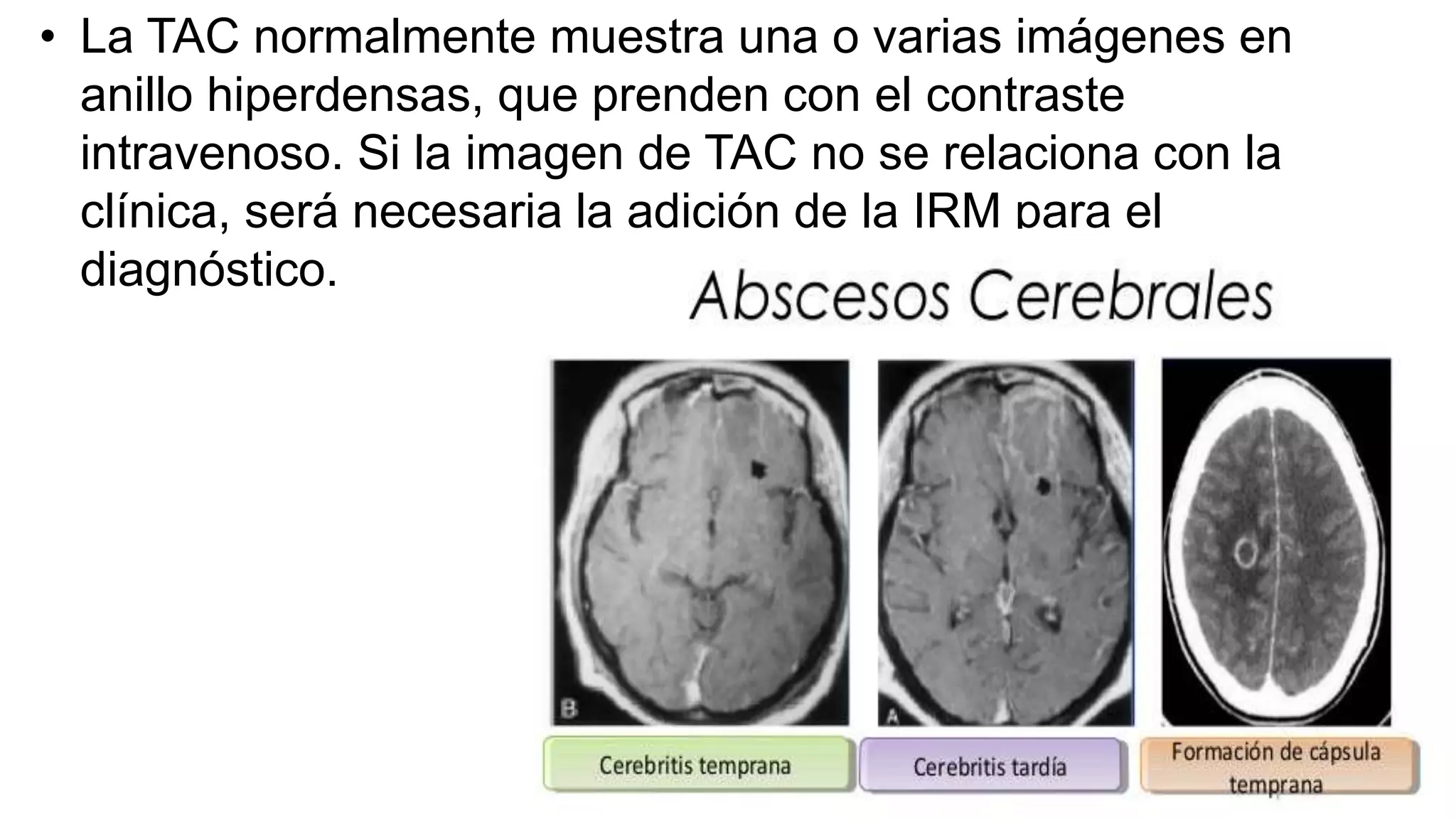 Absceso Cerebral.pptx