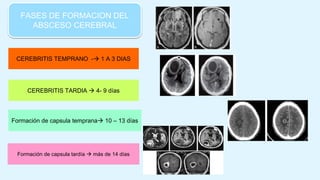 ABSCESO CEREBRAL.pptx