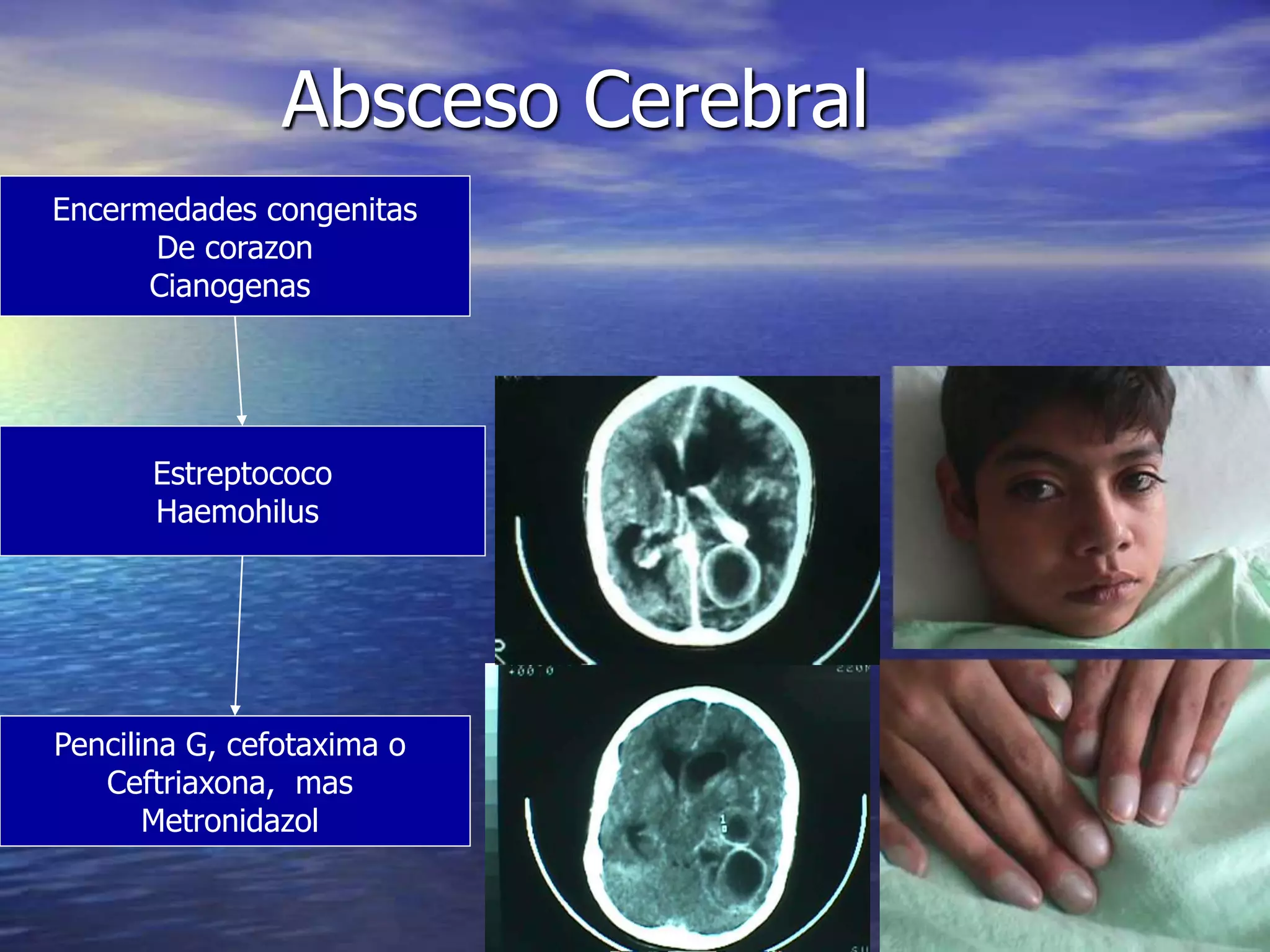 Absceso cerebral 2020 | PPT | Brain and Nervous System Disorders ...