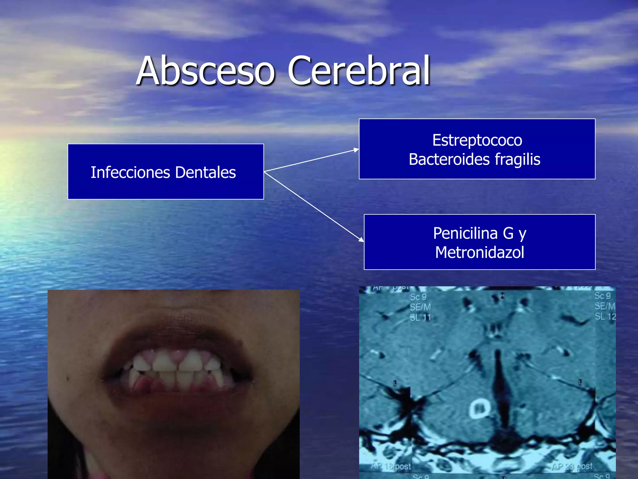 Absceso cerebral 2020 | PPT | Brain and Nervous System Disorders ...
