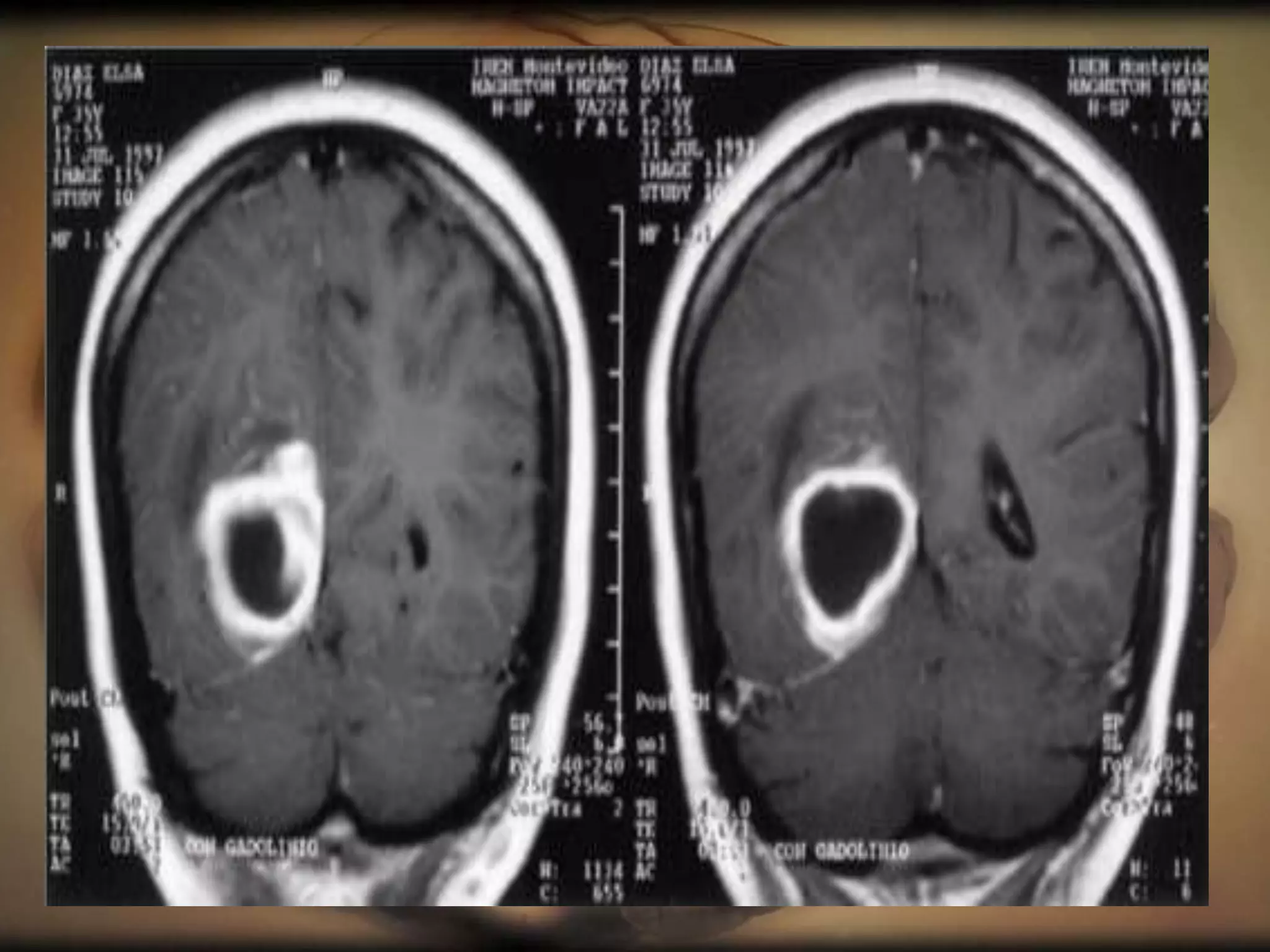 Absceso cerebral | PPT