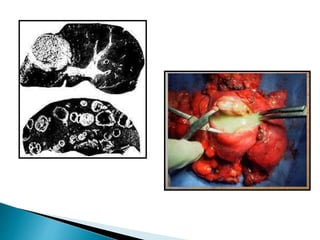 Absceso | PPT