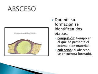 Absceso | PPT