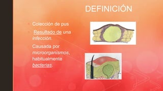 absceso completo PATOLOGIA Y TIPOS DE ABSCESOS.ppt