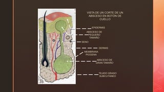 absceso completo PATOLOGIA Y TIPOS DE ABSCESOS.ppt