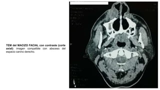 ABSCESO DEL ESPACIO CANINO | PPTX