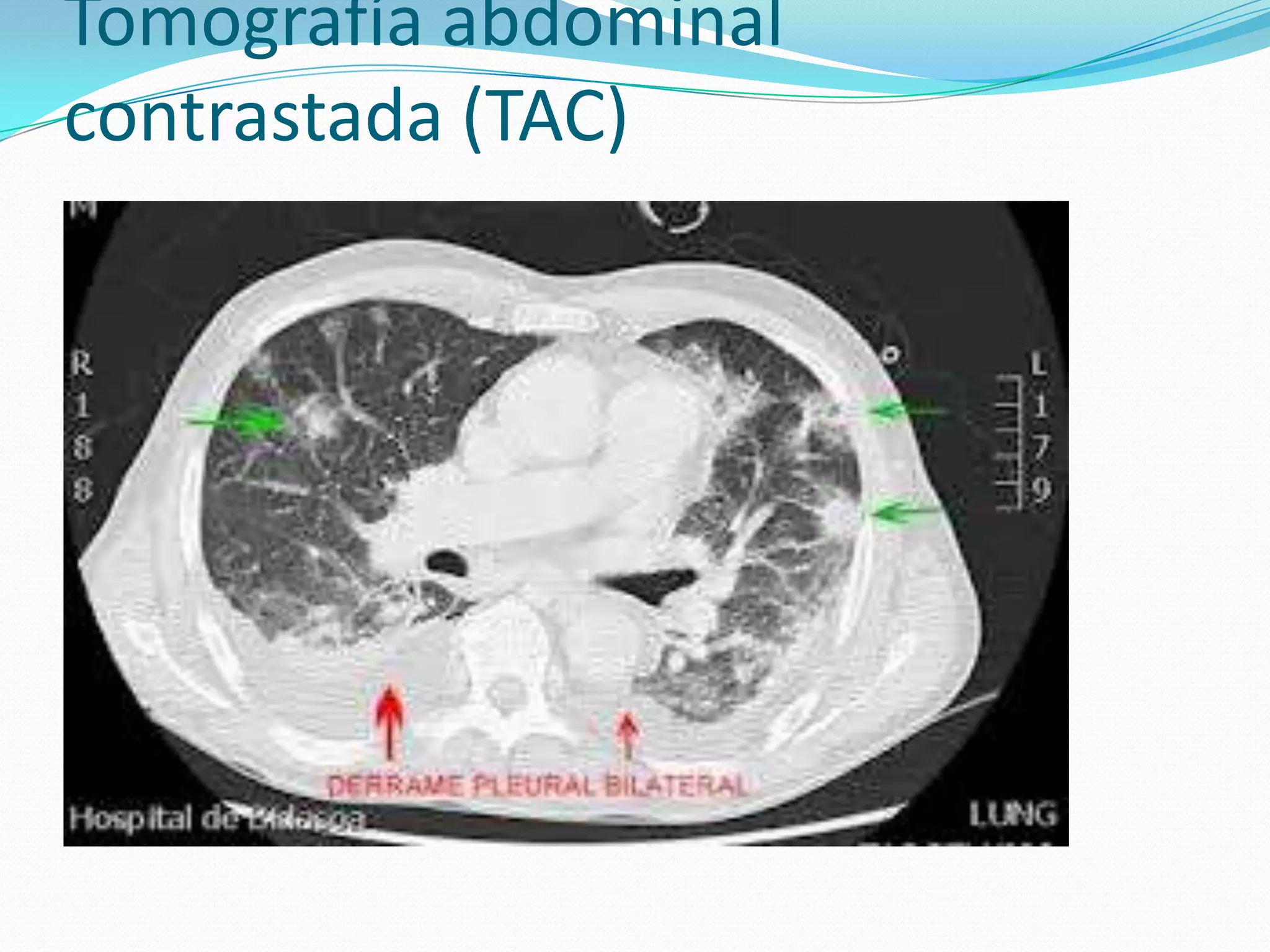Absceso del psoas | PPTX