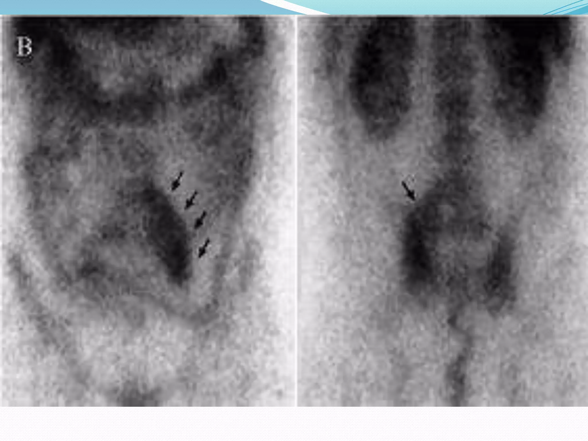 Absceso del psoas | PPTX