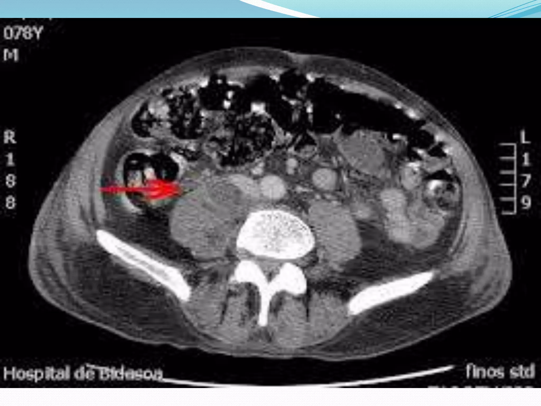 Absceso del psoas | PPT