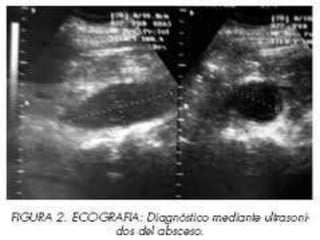 Absceso del psoas | PPTX
