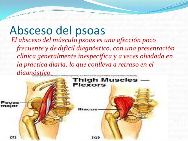 Psoas-Abszess: Definition Und Behandlung – TUIK