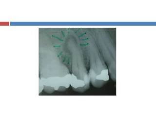Absceso dentoalveolar agudo | PPTX