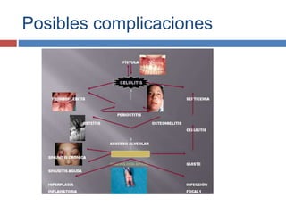 Absceso dentoalveolar agudo | PPTX