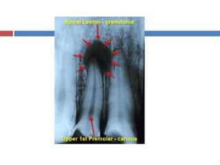 Absceso dentoalveolar agudo | PPTX