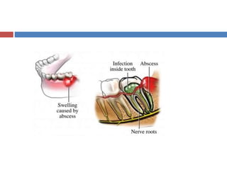 Absceso dentoalveolar agudo | PPTX