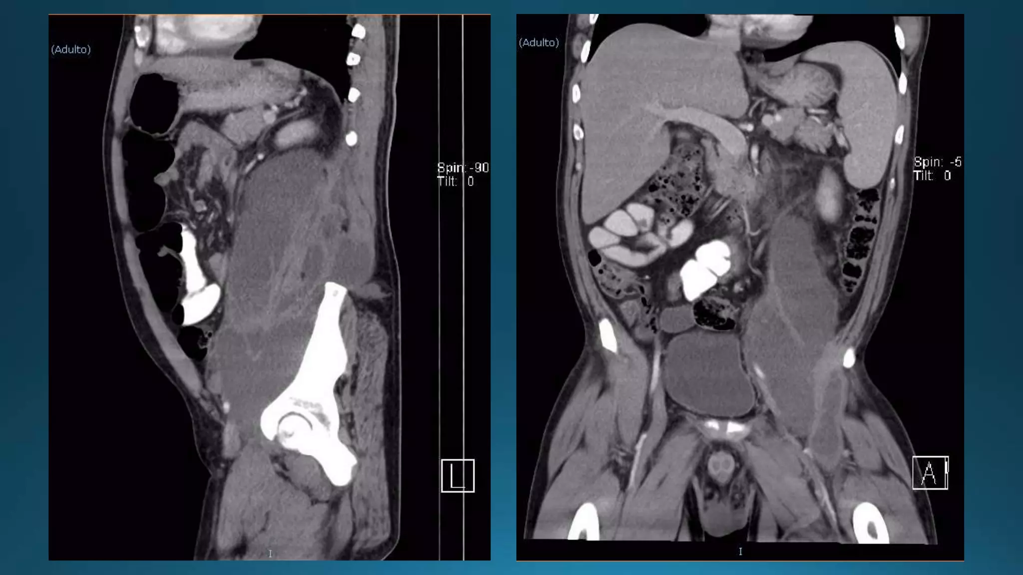 caso clínico: Absceso de psoas | PPTX