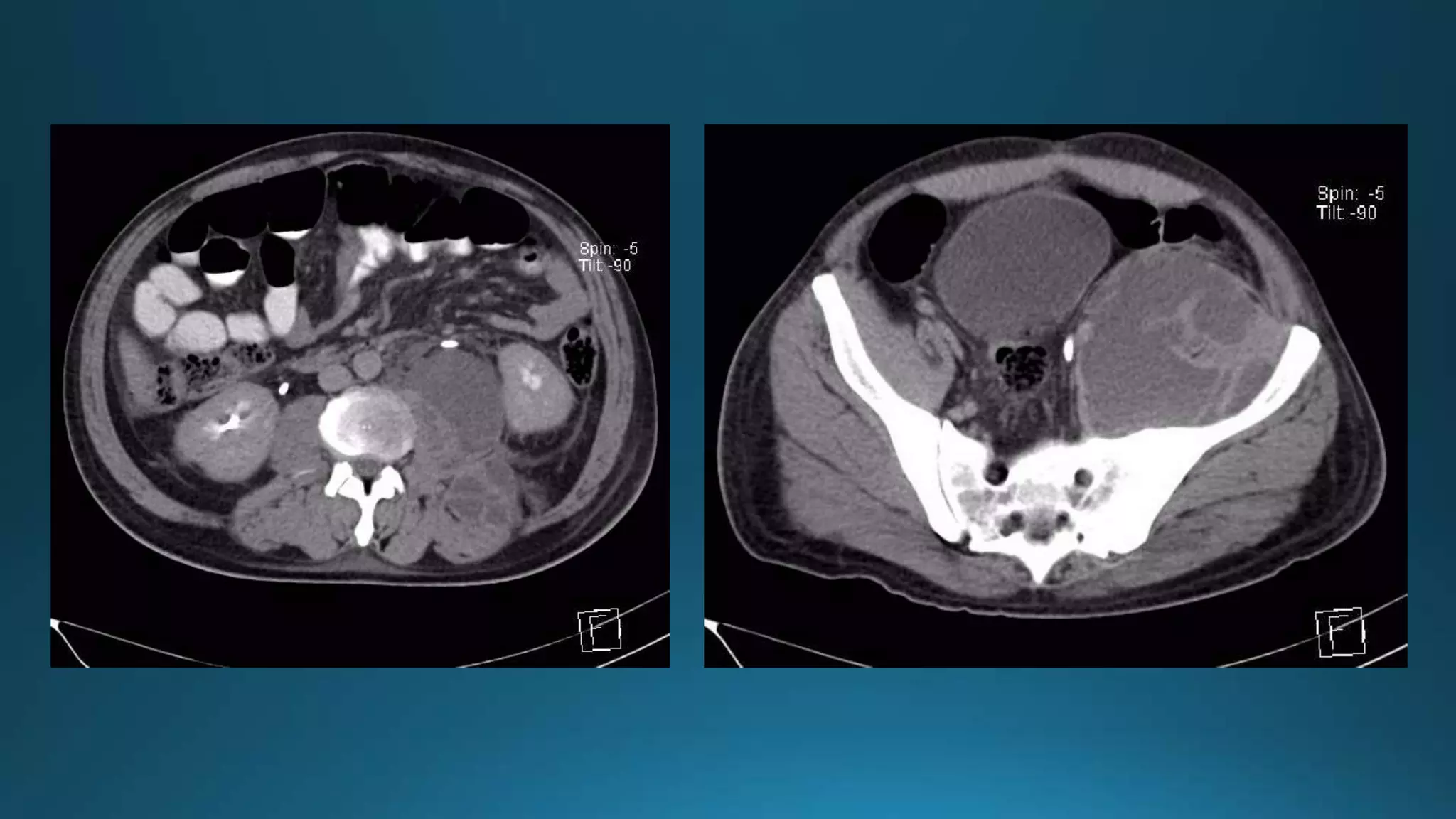 caso clínico: Absceso de psoas | PPTX