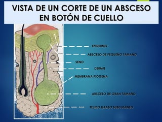 ABSCESO EN CARA RAUL CARDENAS TERAN .ppt