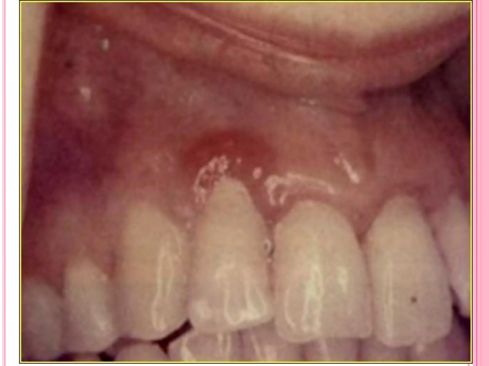 Absceso gingival | PPTX