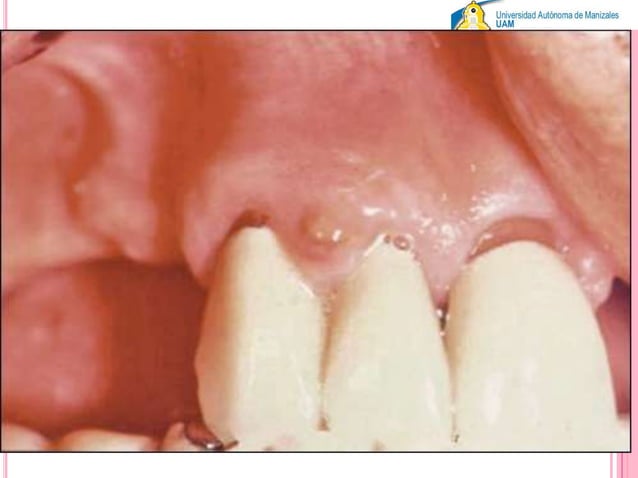 Absceso gingival | PPTX
